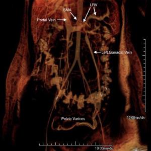Nutcracker Syndrome: A Simplified Approach With Gonadal Vein ...