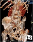 aortoiliac occlusive disease (AIOD) – A Surgeon's Notes