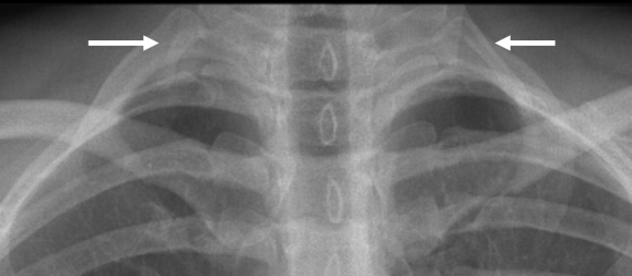 thoracic outlet syndrome – A Surgeon's Notes