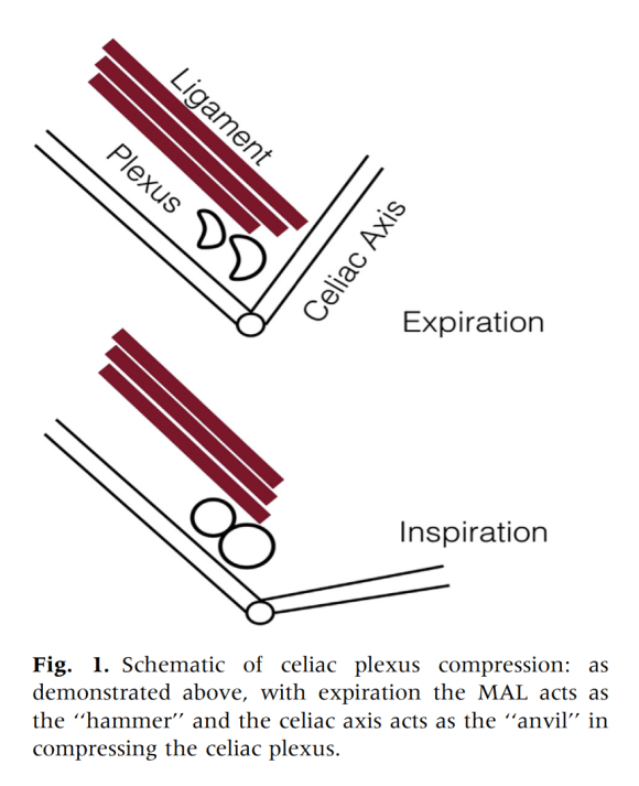 Nonoperative management of median arcuate ligament syndrome (MALS) – A ...