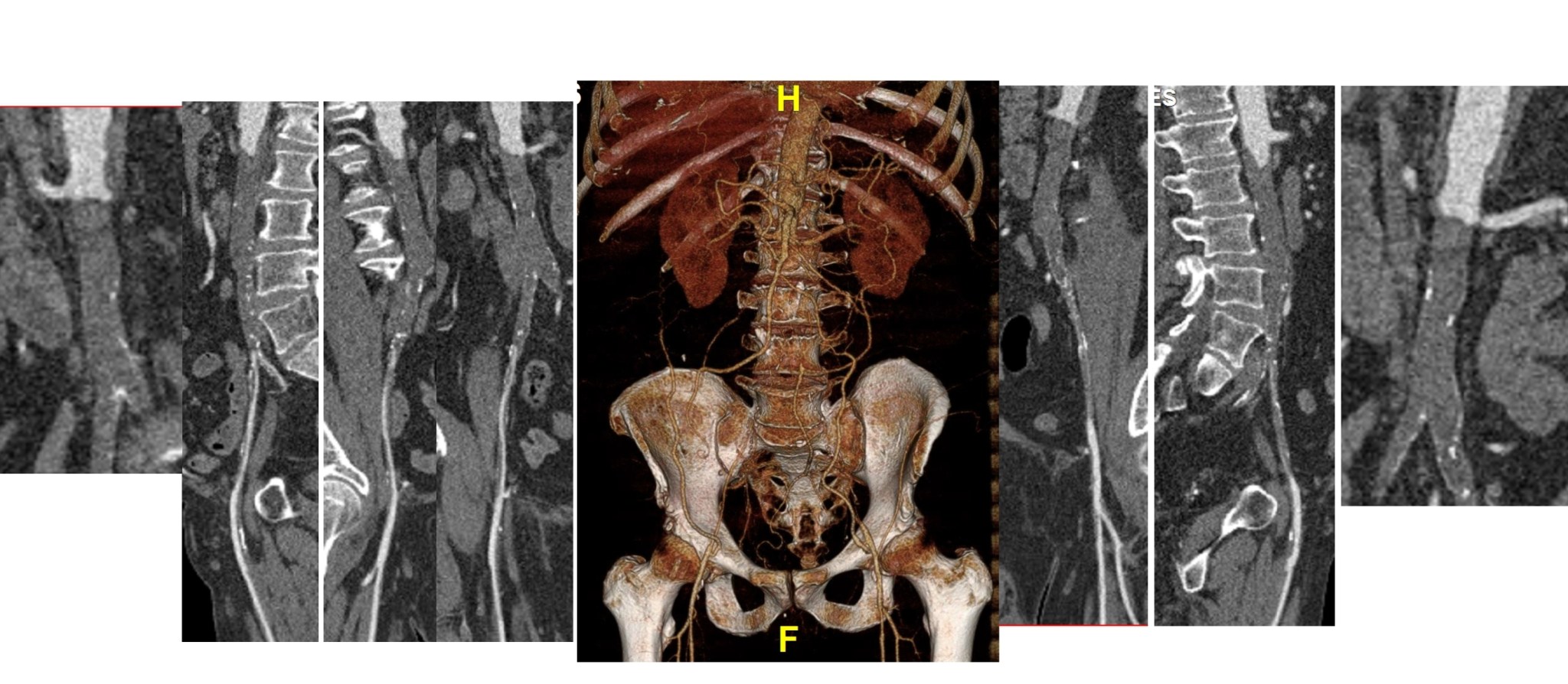 aortoiliac occlusive disease (AIOD) – A Surgeon's Notes