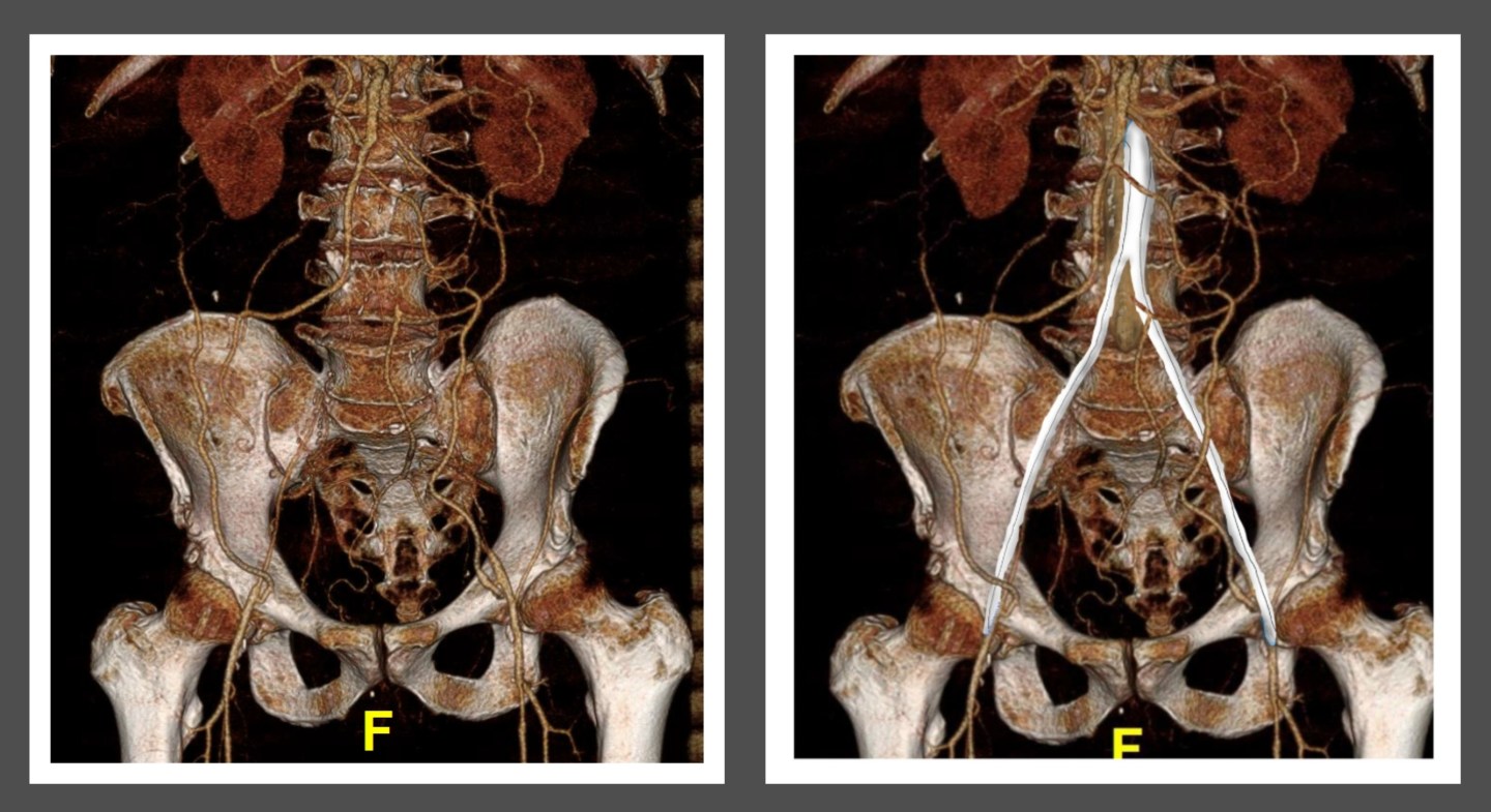 aortoiliac occlusive disease (AIOD) – A Surgeon's Notes