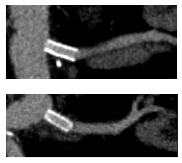 aortoiliac occlusive disease (AIOD) – A Surgeon's Notes