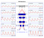 aortoiliac occlusive disease (AIOD) – A Surgeon's Notes