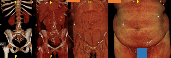aortoiliac occlusive disease (AIOD) – A Surgeon's Notes