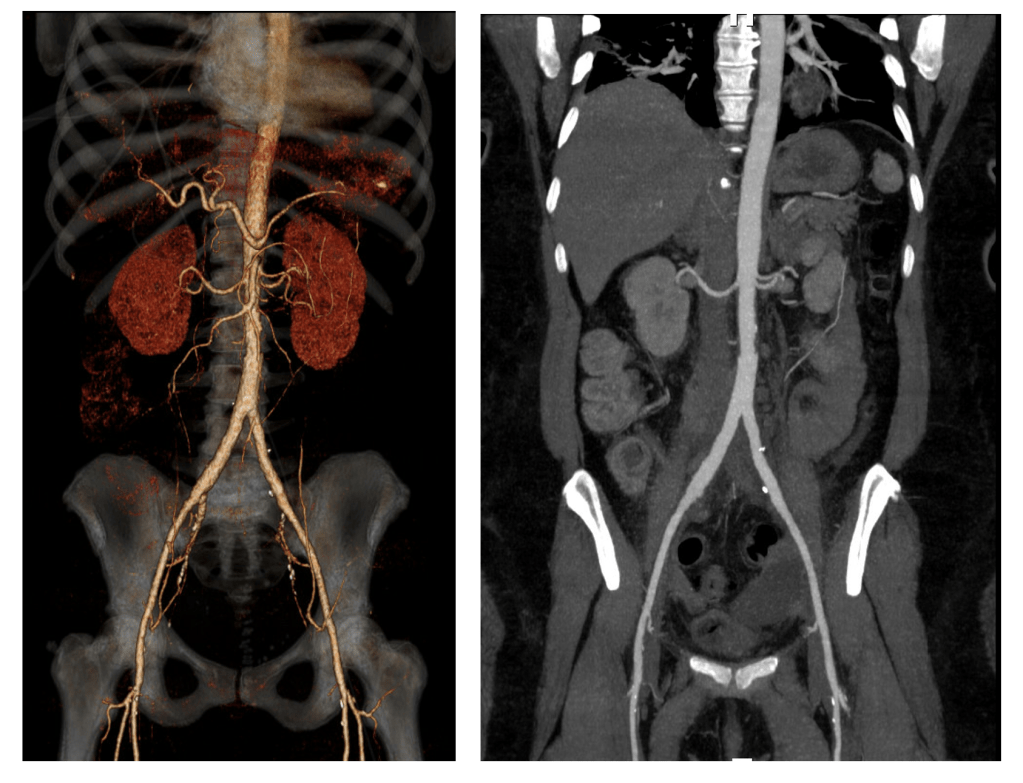 aortoiliac occlusive disease (AIOD) – A Surgeon's Notes