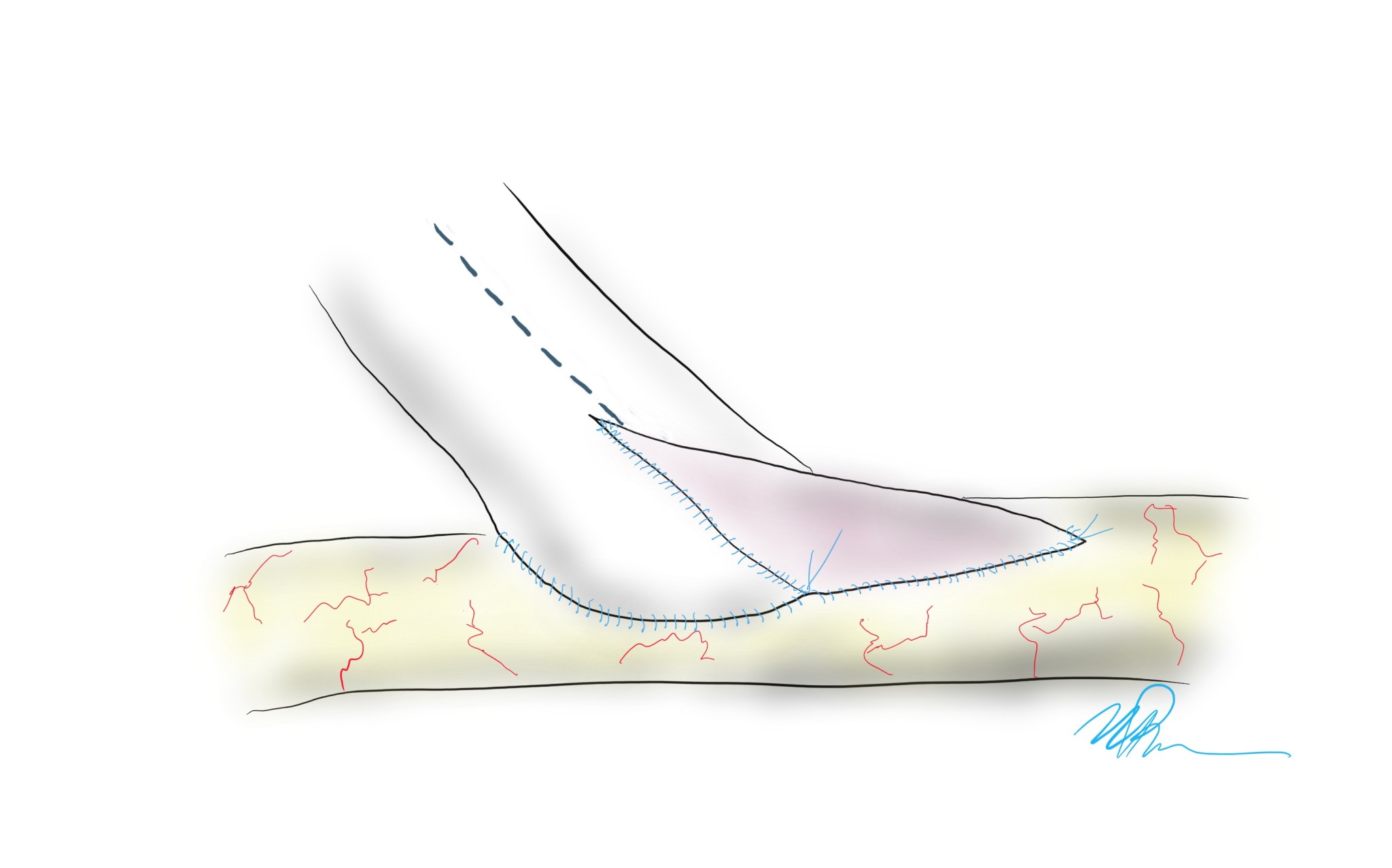 A Surgeon's Notes – to cut is to cure – a vascular surgery blog